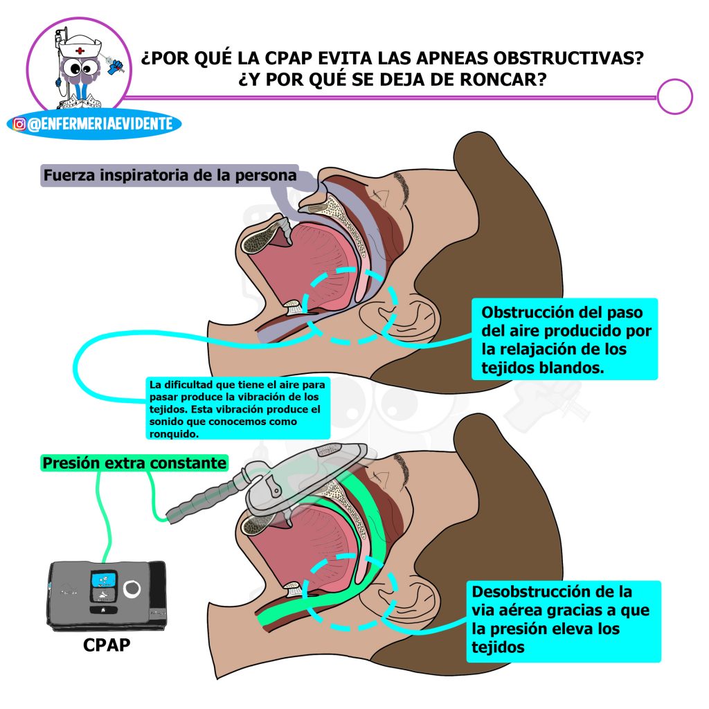 ¿Cómo funciona una CPAP? - Enfermeria Evidente